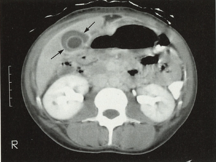 Acalculous Cholecystitis Consultant360